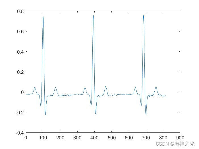 【心电信号 】基于matlab ECG心电信号QRS波群特征提取【含Matlab源码 3385期】_qrs波特征提取-CSDN博客