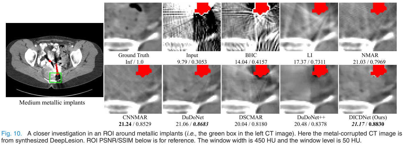 Deep Interpretable Convolutional Dictionary Network for Metal Artifact Reduction in CT Images_卷积 ...