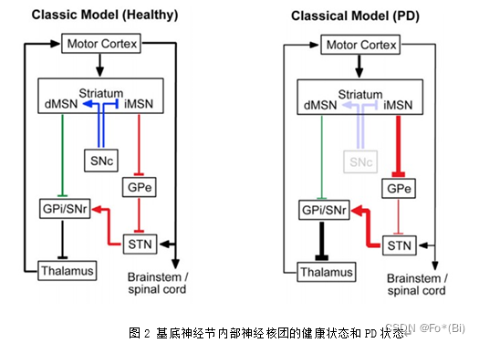 2021年中国研究生数学建模竞赛C题——帕金森病的脑深部电刺激治疗建模研究_帕金森病是一种常见的神经退行性疾病,临床表现的特征是静止性震颤,肌强直,运动迟-CSDN博客