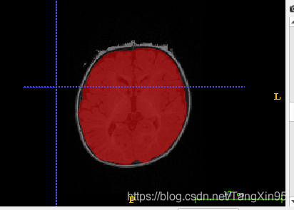 MRI预处理-去颅骨_python ct图像颅骨去除-CSDN博客