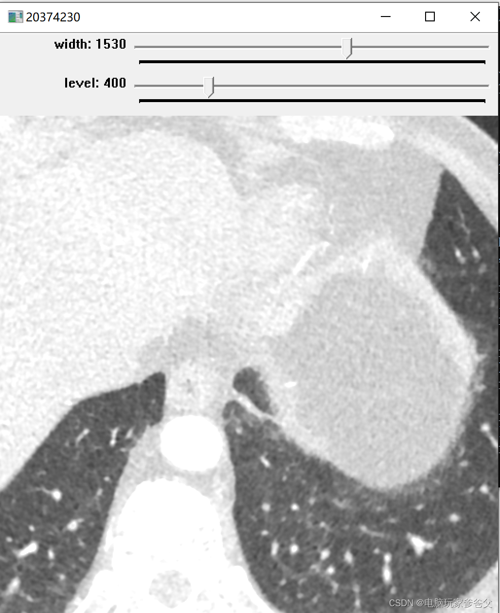 Opencv 实验:实现窗宽窗位调节(附源码及解析)医学影像切片显示与窗宽窗位调节 实验目的 掌握图像矩阵的像素访问方 Csdn博客