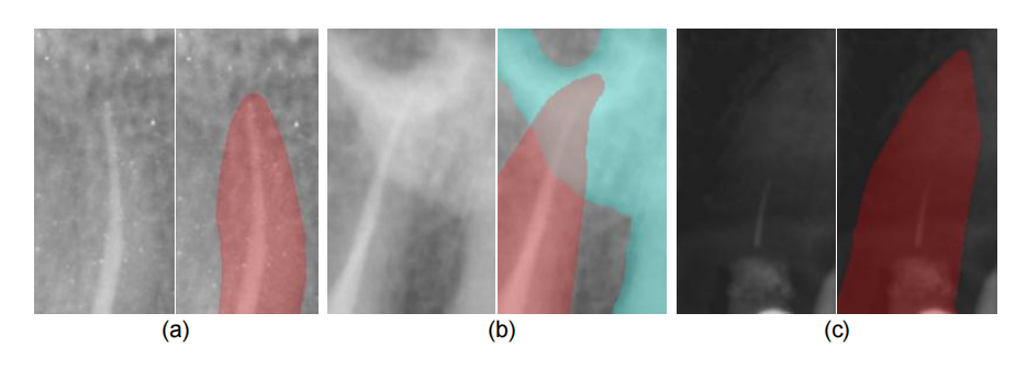 论文阅读笔记-GT U-Net: A U-Net Like Group TransformerNetwork for Tooth Root ...