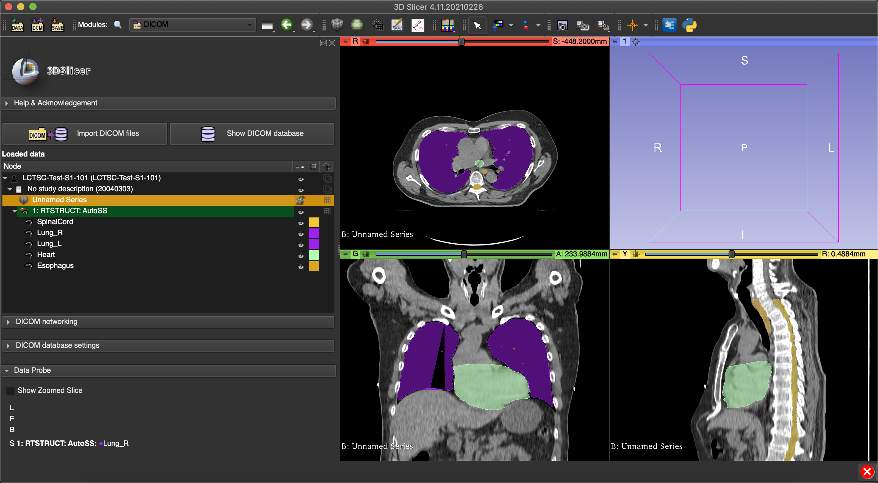 DICOM-RT struct在python中显示mask以及使用3d Slicer转换为nii_吨吨不打野的博客-CSDN博客