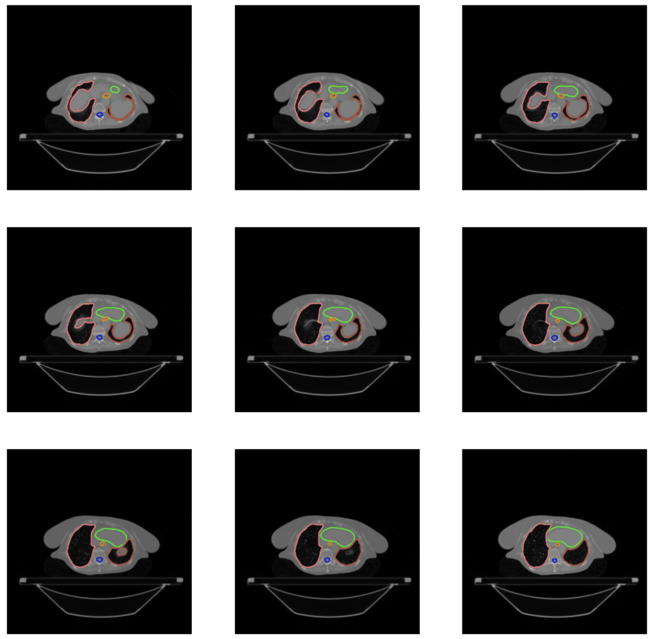 DICOM-RT struct转换为nii.gz_rtstruct-CSDN博客