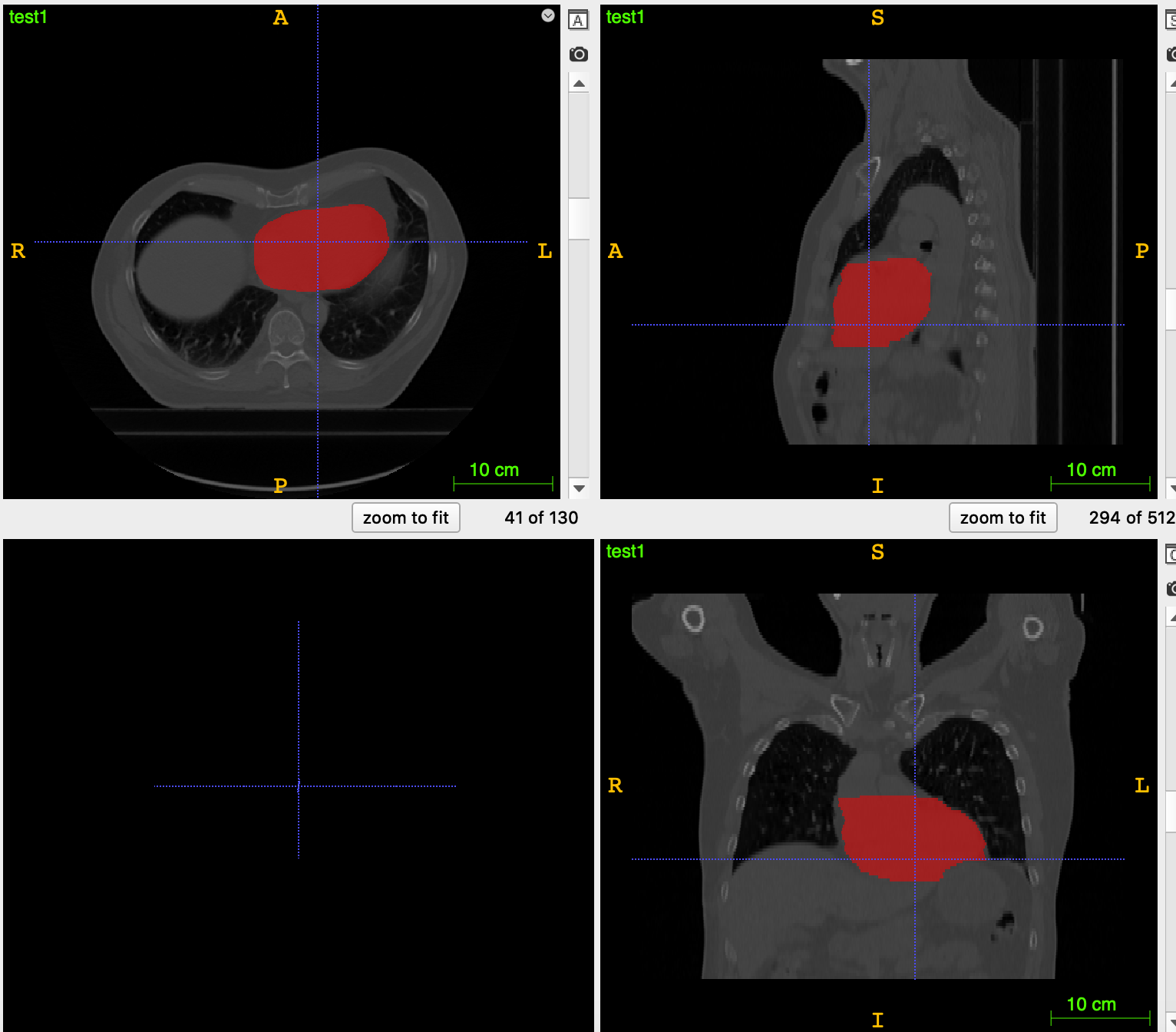 DICOM-RT struct在python中显示mask以及使用3d Slicer转换为nii_吨吨不打野的博客-CSDN博客