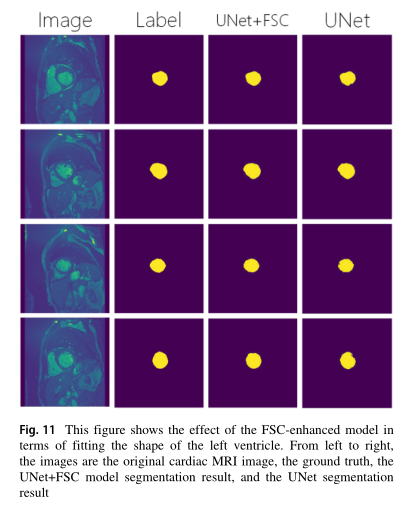 MMNet: A multi-scale deep learning network for the left ventricular segmentation of cardiac MRI ...