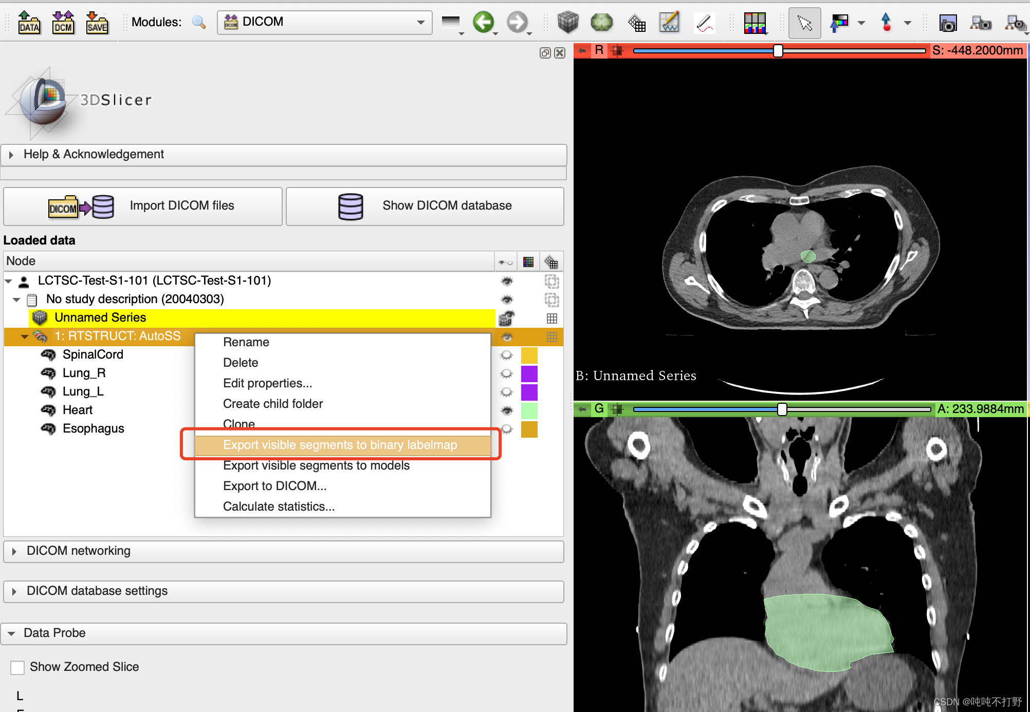 Dicom Rt Struct在python中显示mask以及使用3d Slicer转换为nii吨吨不打野的博客 Csdn博客