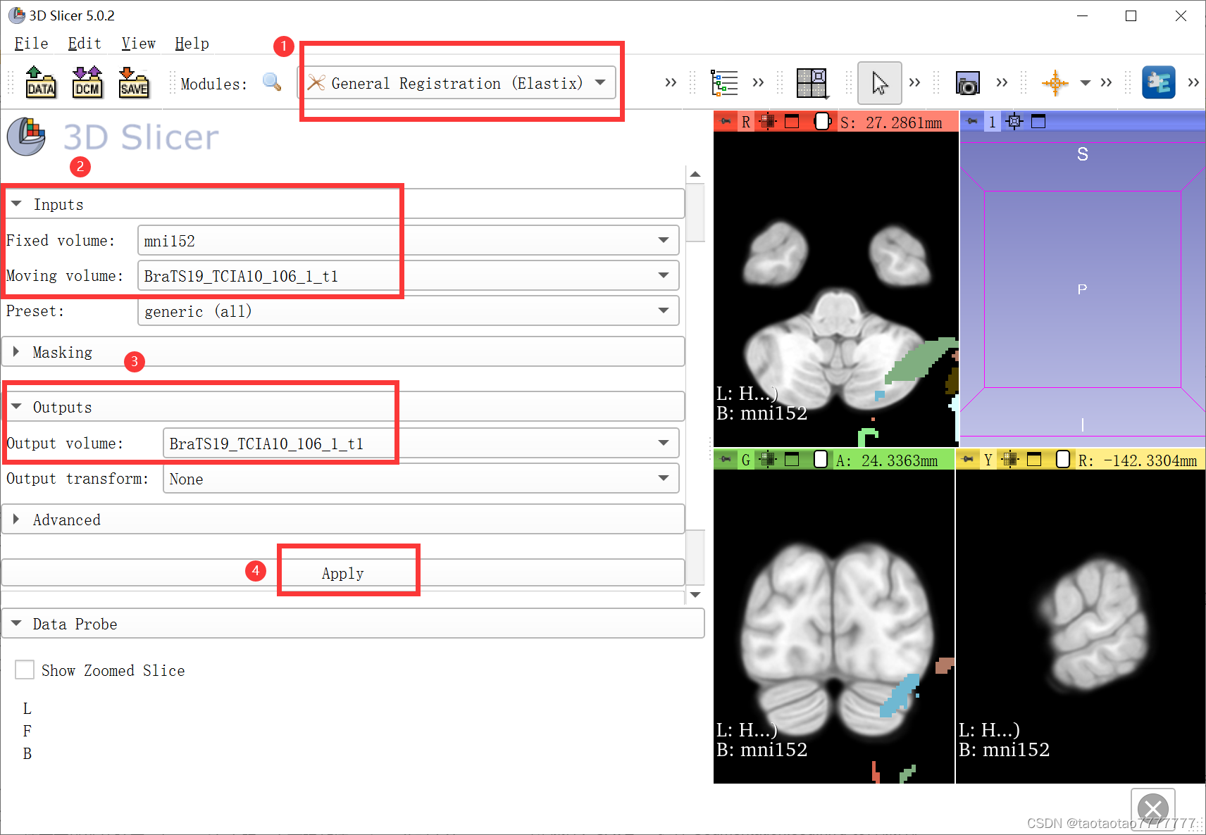 【影像组学】基于 atlas 感兴趣区提取 (3D slicer)_3dslicer 生成标准头模-CSDN博客