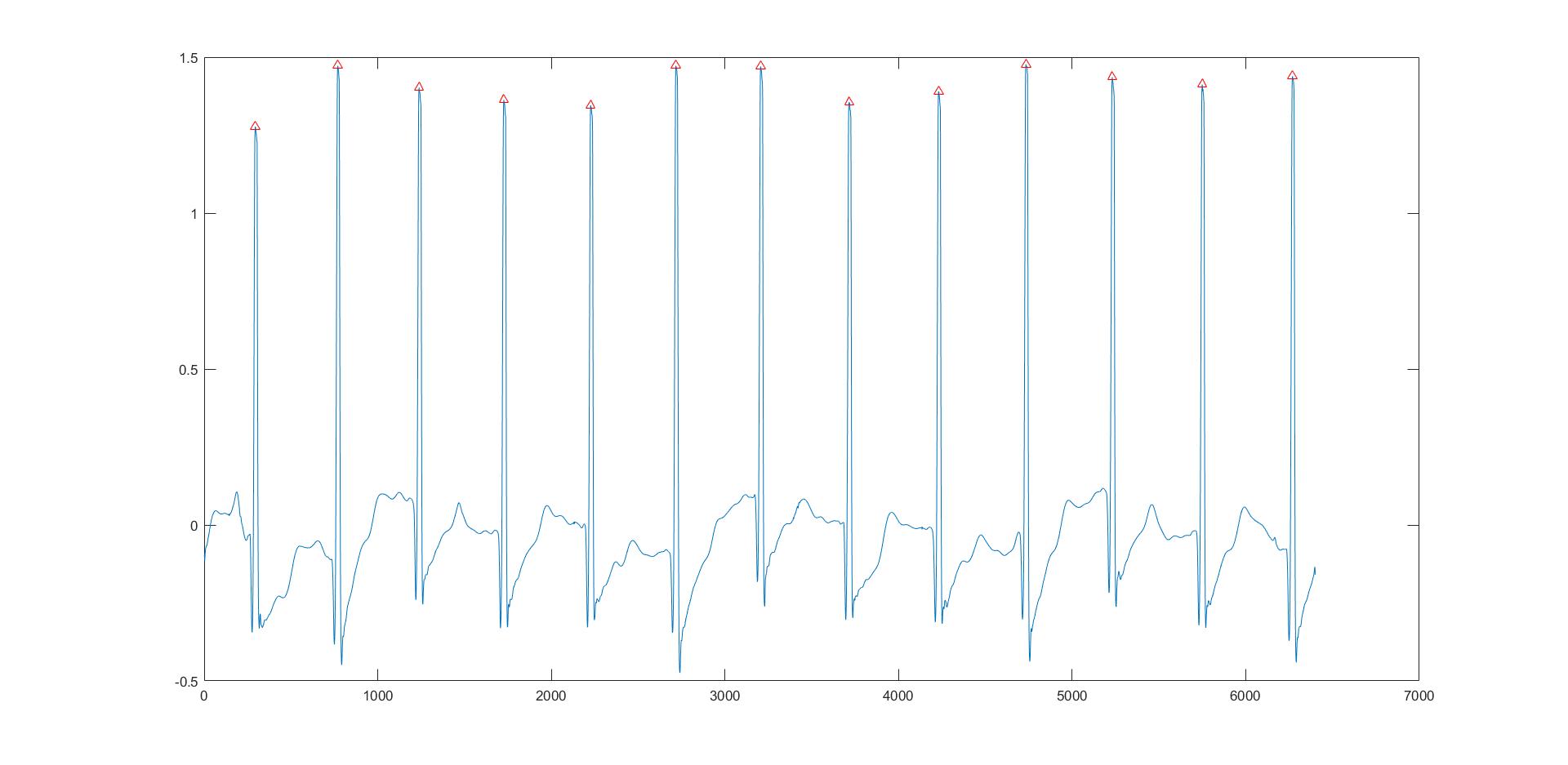 【代码补全】matlab心电信号R波提取_matlab qrs间期提取_ergozzzzzza的博客-CSDN博客