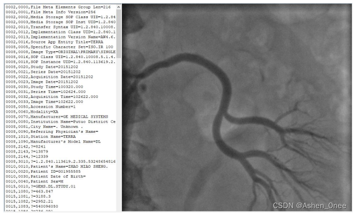 8月26日计算机视觉理论学习笔记——医疗影像分割_nrrd模型-CSDN博客