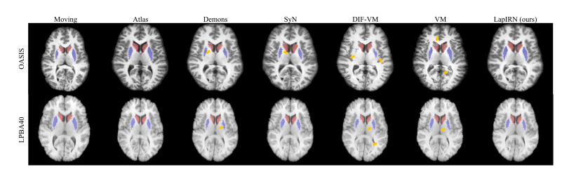 论文笔记：Large Deformation Diffeomorphic Image Registration with Laplacian Pyramid Networks-CSDN博客