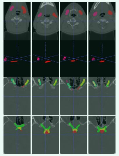 AnatomyNet: Deep Learning for Fast and Fully Automated Whole-volume ...