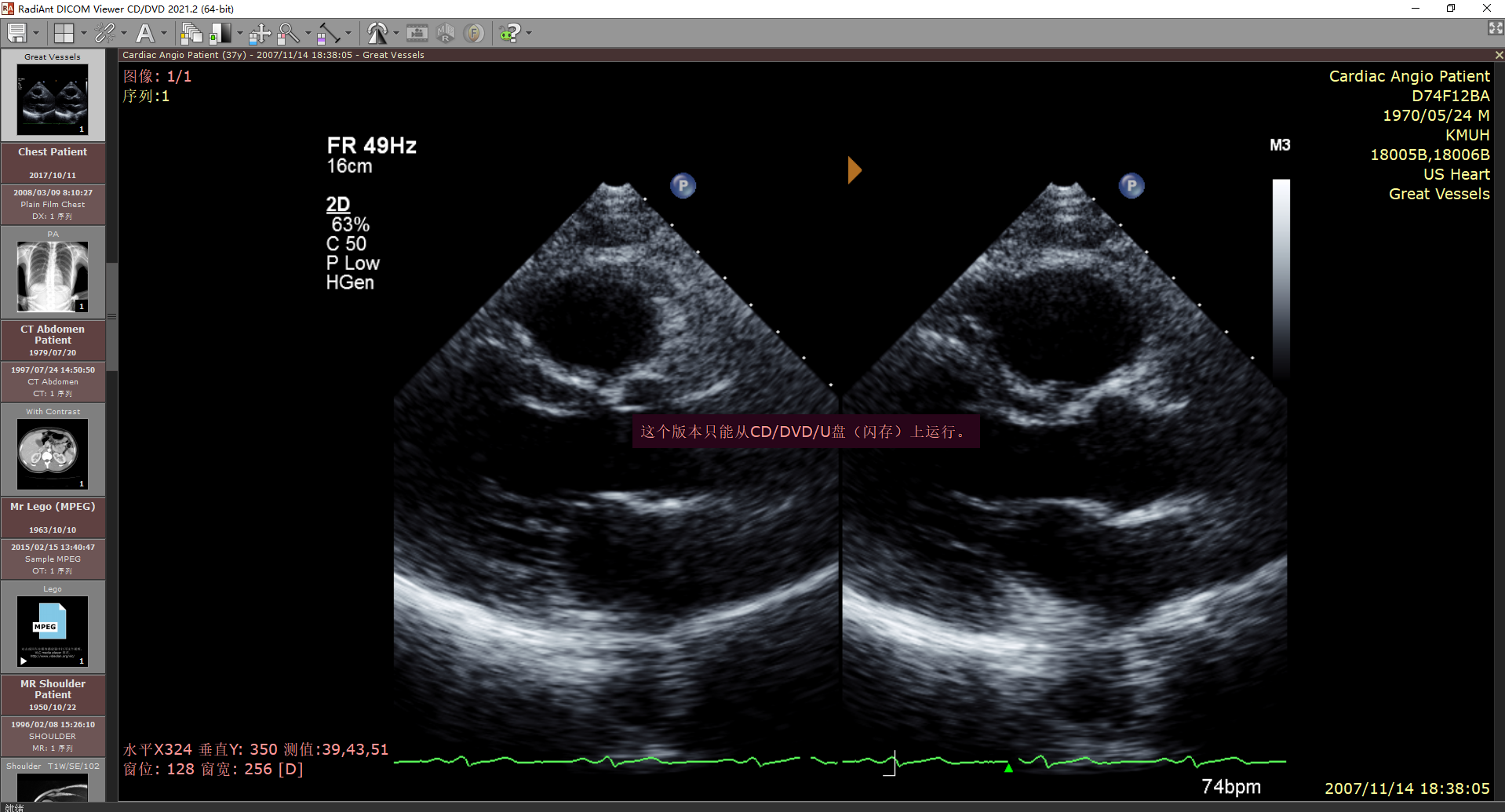 RadiAnt DICOM Viewer CD/DVD -U盘版_raduant dicom-CSDN博客