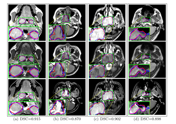 MMFNet: A Multi-modality MRI Fusion Network for Segmentation of Nasopharyngeal Carcinoma_multi ...