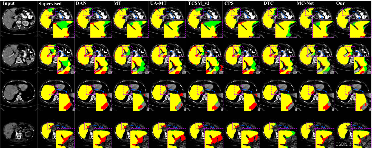 【医学分割】Semi-supervised medical image segmentation network ASE-Net_semi-supervised medical image ...