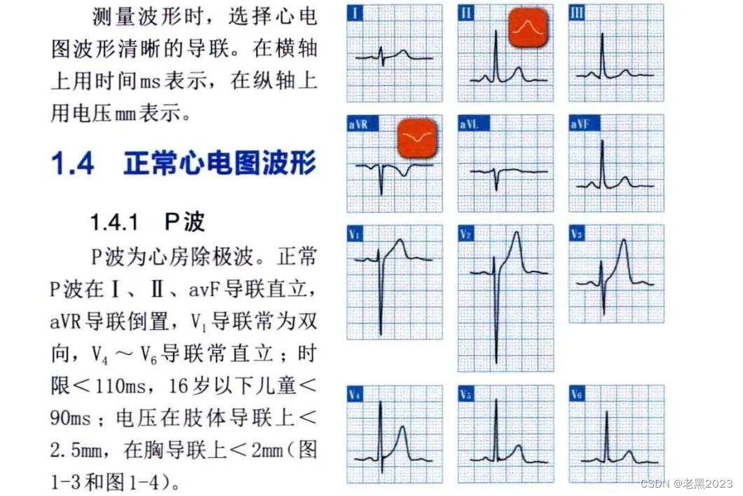 心电图基础之P-QRS-T波形-CSDN博客