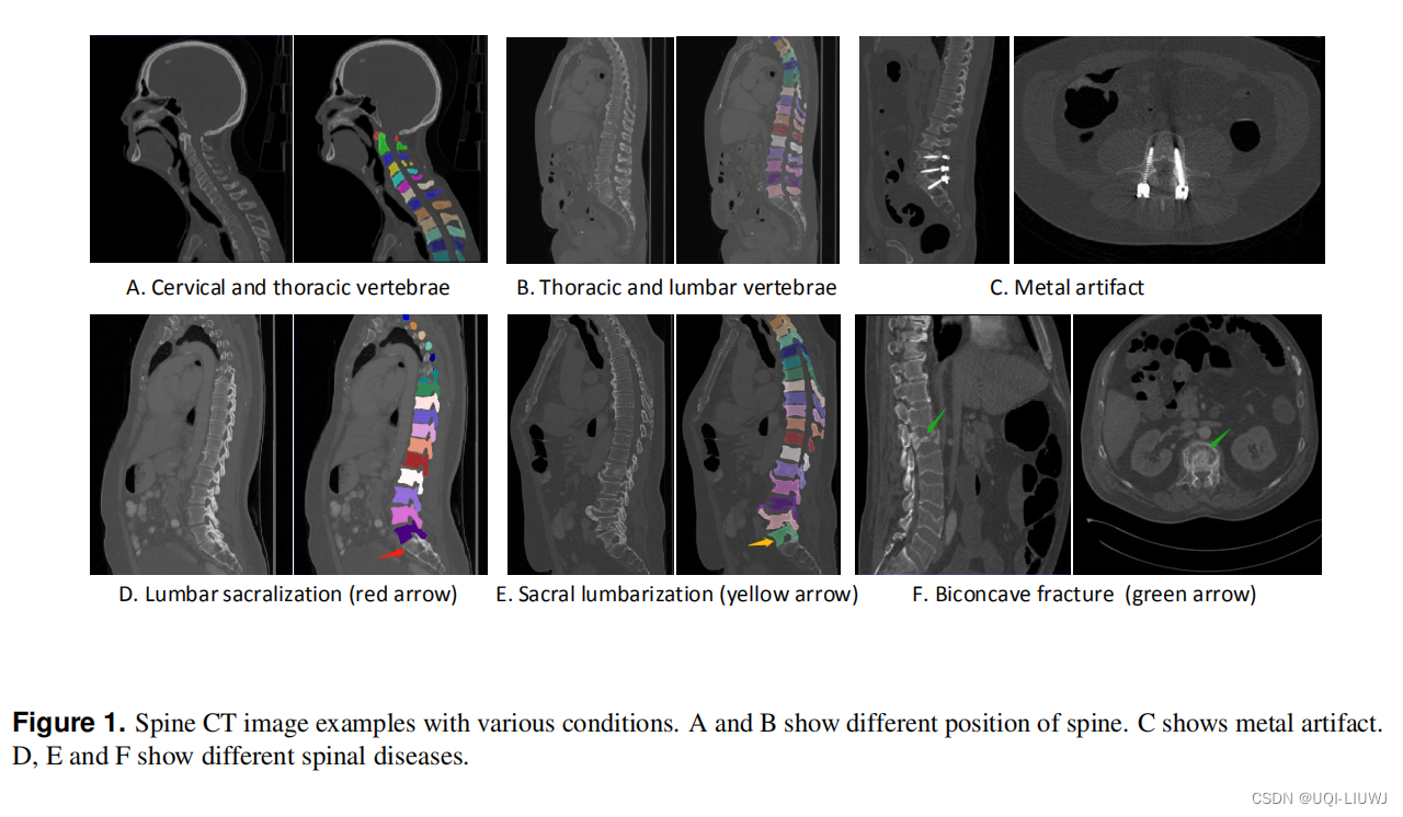 论文笔记：CTSpine1K: A Large-Scale Dataset for Spinal Vertebrae Segmentation ...