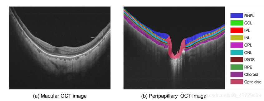 【论文笔记】MGU-Net_duke sd-oct dataset-CSDN博客