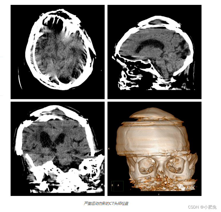 CT伪影：根本原因与规避方法_小鼠ct运动伪影-CSDN博客