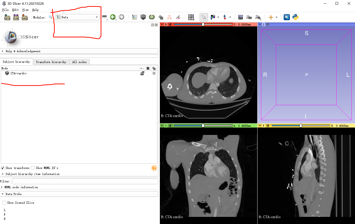 3D slicer分割器官的步骤简介(二) : 自动分割_3dslice对肺段进行划分-CSDN博客