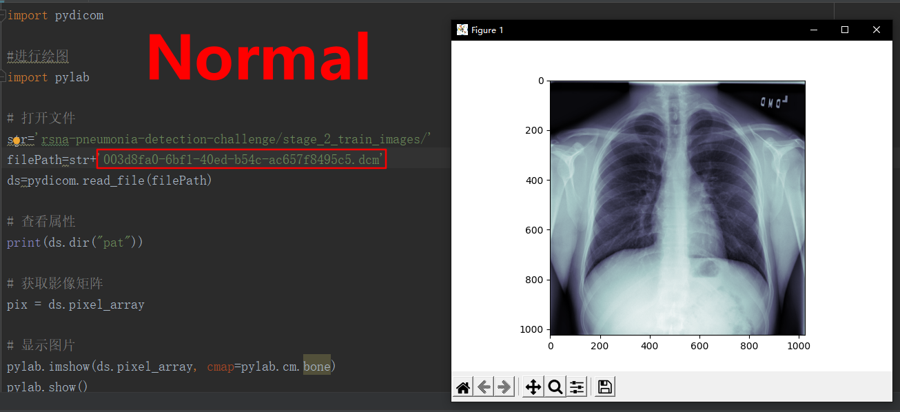 RSNA Pneumonia Detection Challenge项目简单学习＜1＞_rsna数据集的两个class-CSDN博客