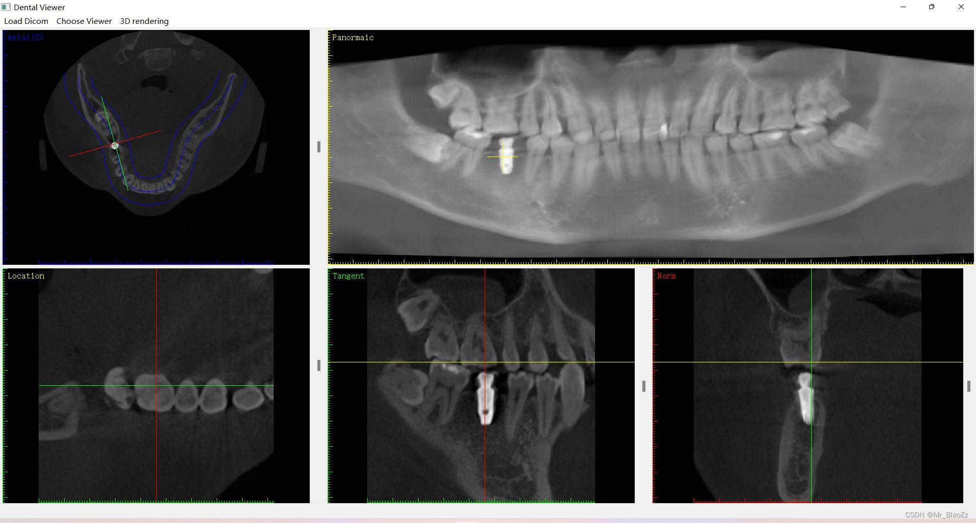 牙科医学四视图+vtk三维重建+口腔全景图像重建（pyqt5+python）- V2.0_全景片重建模块计算采样点的重建像素值,将采样点的重建像素值作为口腔全景片图像-CSDN博客