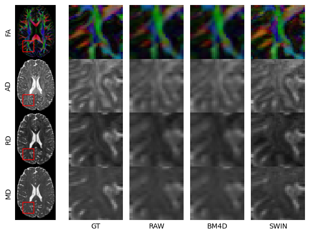 Generalized Diffusion MRI Denoising and Super-Resolution using Swin ...