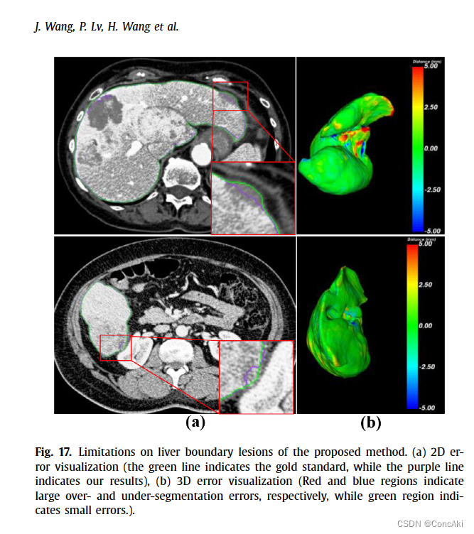 “SAR-U-Net: Squeeze-and-excitation block and atrous spatial pyramidpooling based residual U-Net ...