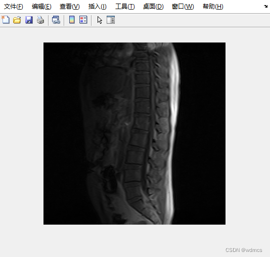 ＜Matlab医学图像处理(1)＞DICOM图像读取与显示_用matlab读取和显示待处理的医学图像并显示影像信息-CSDN博客