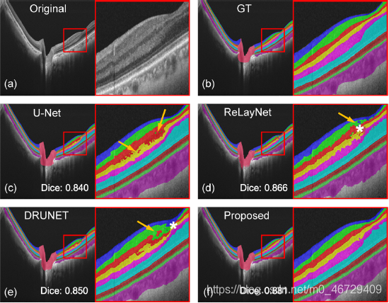 【论文笔记】MGU-Net_duke sd-oct dataset-CSDN博客
