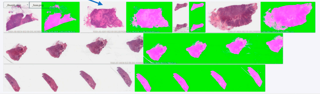 [病理图像质控]分割病理图像（whole slide images，WSI）中包含组织的区域，去掉空白区域_病理图像分割-CSDN博客