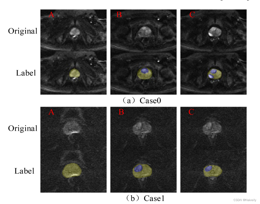论文笔记A dual attention-guided 3D convolution network for automatic ...