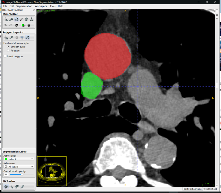 ITK-snap医学图像标注方法（超级详细）——保姆级_itk snap-CSDN博客