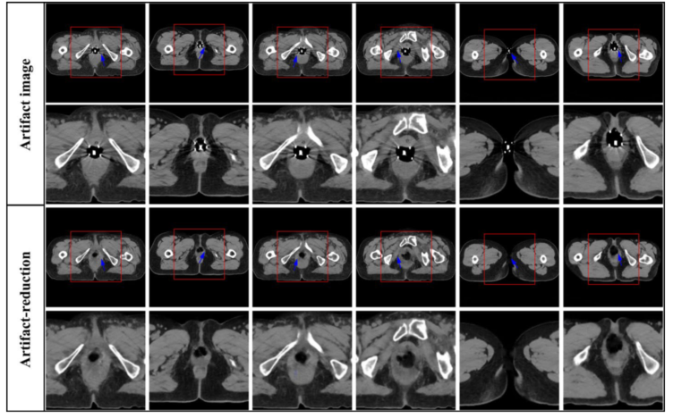 Metal artifact reduction on cervical CT images by deep residual learning-CSDN博客