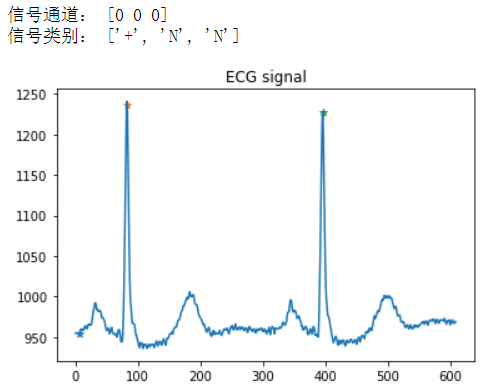 心电数据集MIT-BIH处理_心电图图像数据集-CSDN博客