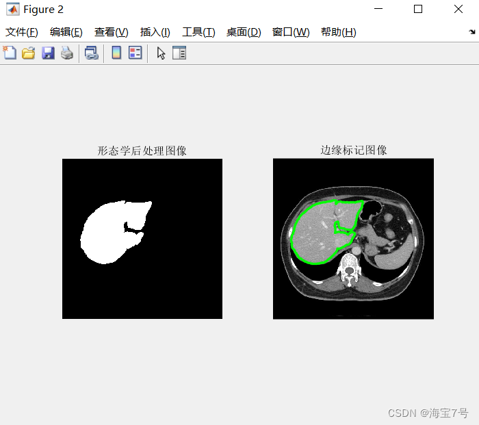 【第 26 章 基于最小误差法和区域生长的医学影响分割系统 Matlab深度学习实战gui项目】基于matlab Gui的医用系统开发