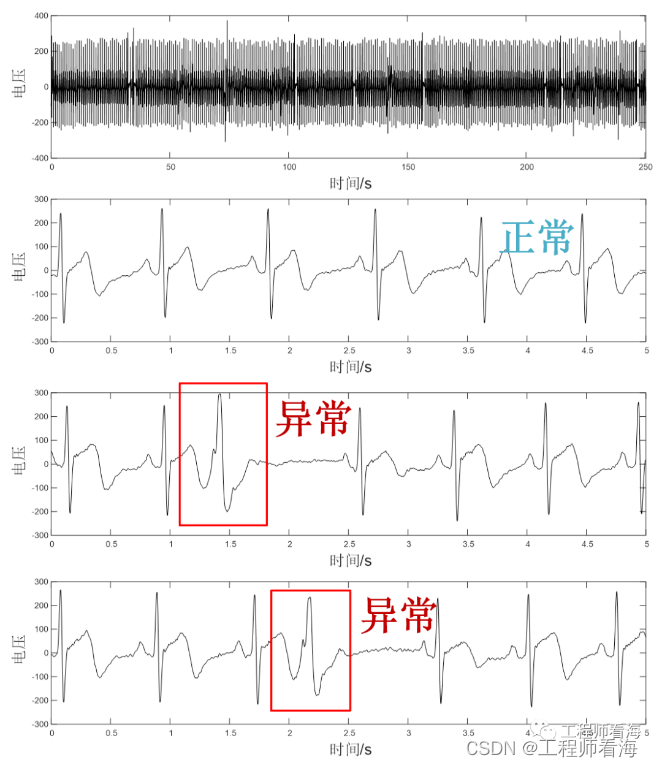 工程师生病了怎么办？自己做电路给自己测：ECG与心脏早搏_android 绘制ecg心电波形 csdn-CSDN博客