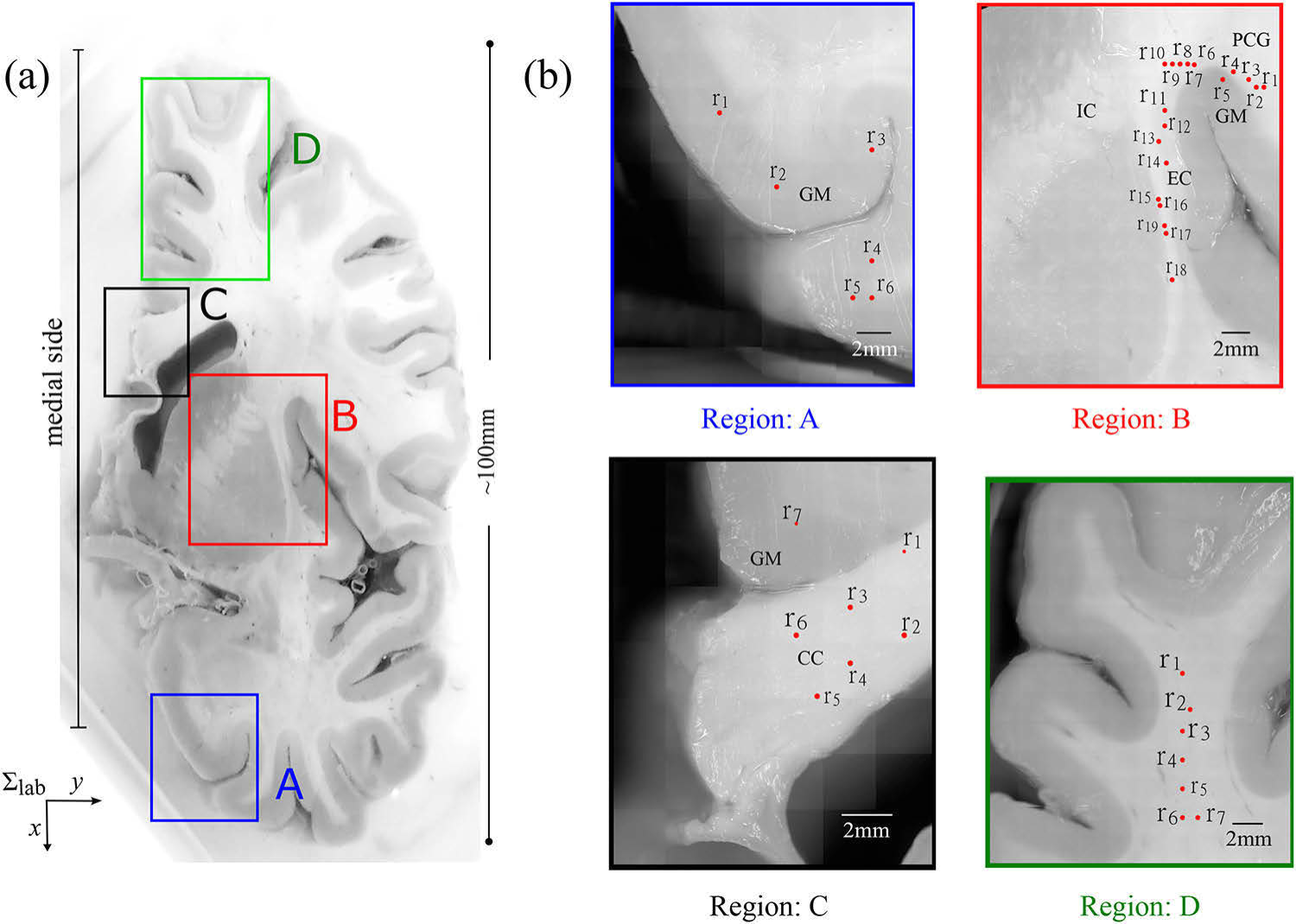 [原文] Application of Polarization Imaging Techniques in Brain Tumor ...