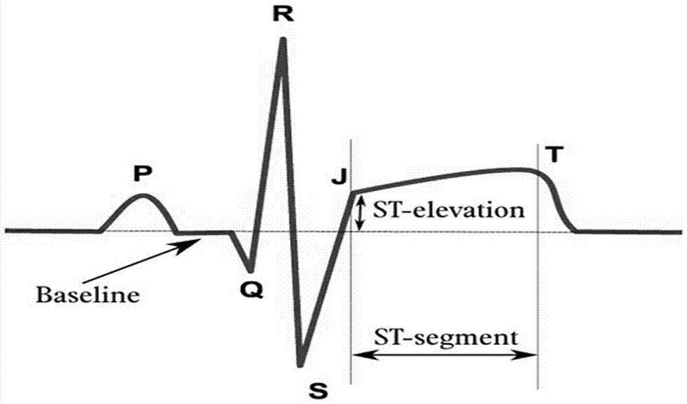 python MIT-BIH 数据集心拍分类 从R点提取到19类R点心拍分类到AAMI标准5分类的数据集打包实现 良心详解版 全网唯一_mit-bih arrhythmia database ...