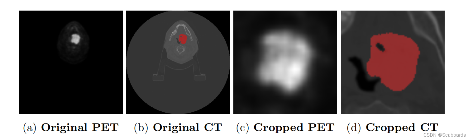 TMSS: 一个端对端的用于分割以及生存预测的基于transformer的多模态网络_tmss: an end-to-end ...