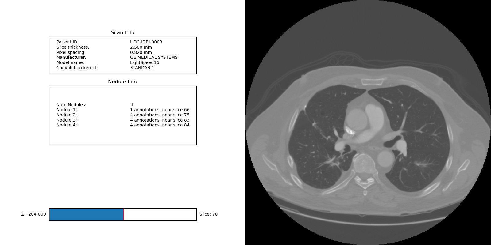 【深度学习】肺结节分割项目实战一：处理数据集_lidc-idri数据集深度学习预处理-CSDN博客