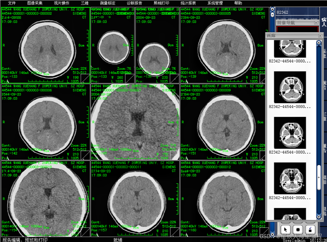 影像科PACS系统：CT断层扫描_pacs ct-CSDN博客