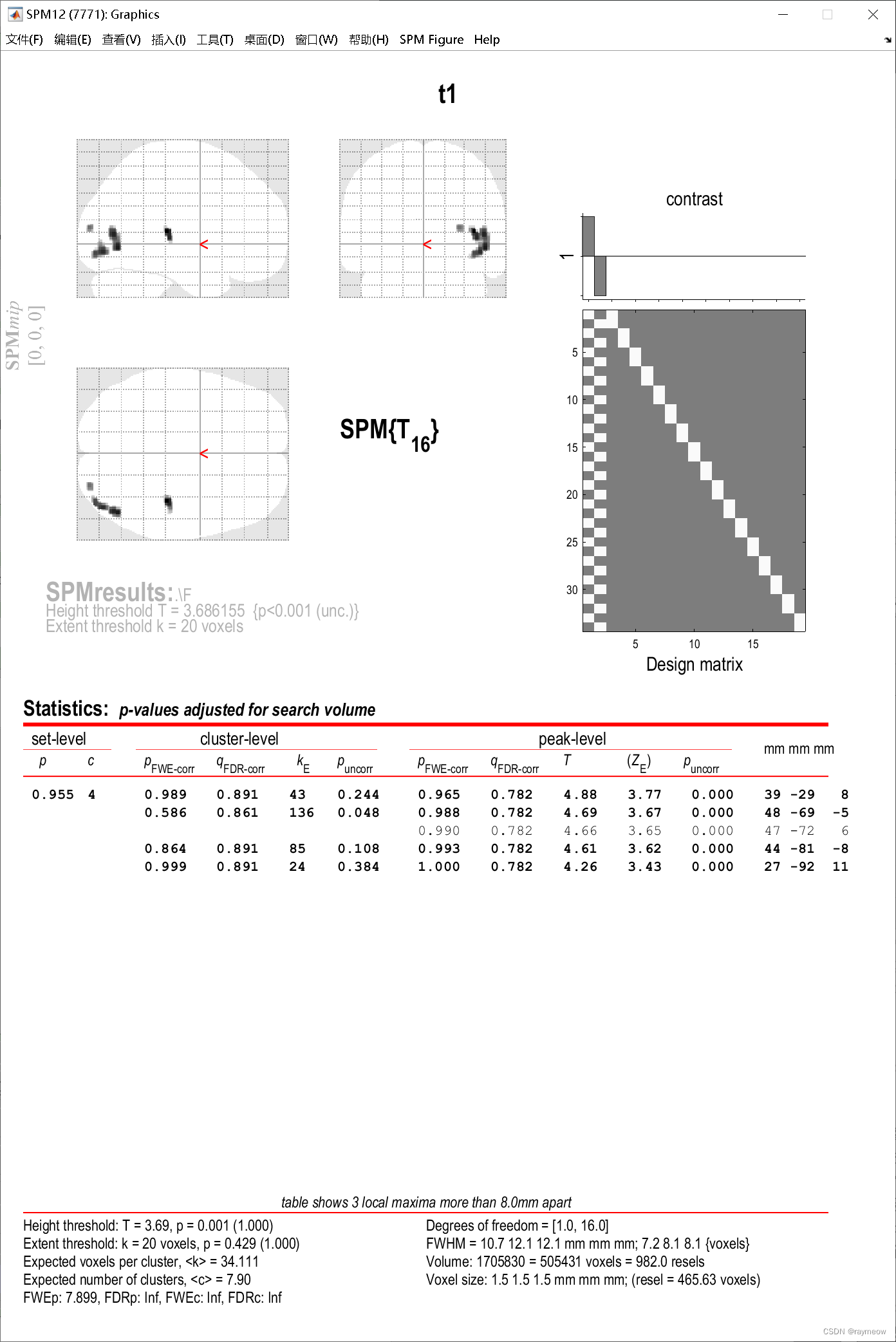 CAT12中纵向数据Basic Models在SPM12中Estimate后出现Design Matrix错误不能Define ...