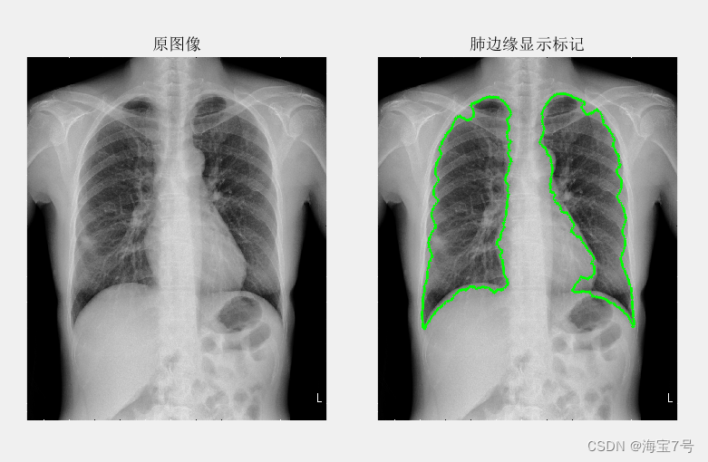 【第 26 章 基于最小误差法和区域生长的医学影响分割系统 Matlab深度学习实战gui项目】基于matlab Gui的医用系统开发 Csdn博客