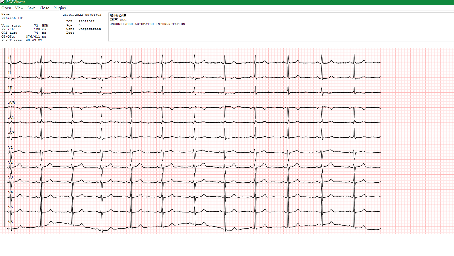 静态心电设备的数据采集（aECG）_java心电数据转换成hl7aecg xml文件-CSDN博客