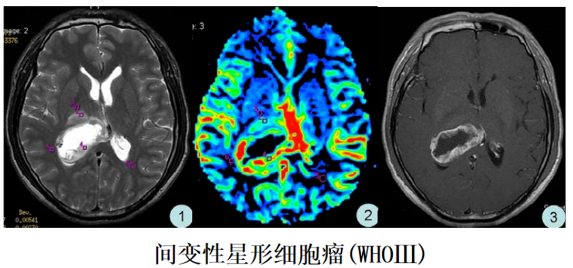 脑灌注成像学习总结_脑灌注ctp-CSDN博客