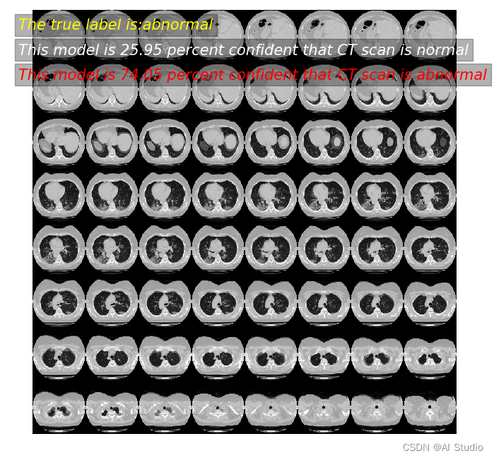 Mosmeddata 新冠肺炎胸部 Ct扫描数据集上基于3d Cnn实现二分类3d医学影像二分类网络 Csdn博客
