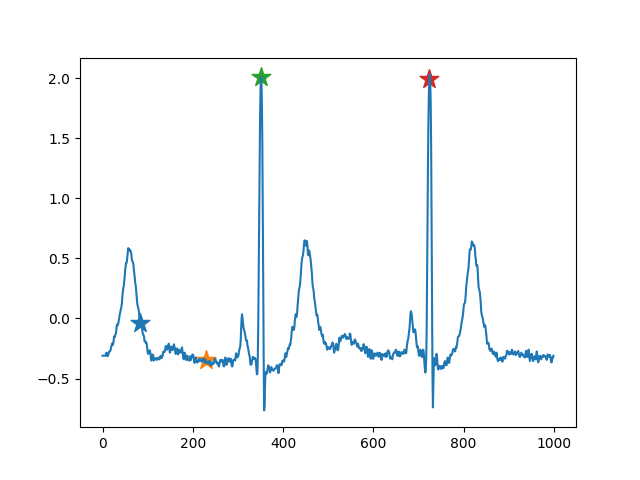 python MIT-BIH 数据集心拍分类 从R点提取到19类R点心拍分类到AAMI标准5分类的数据集打包实现 良心详解版 全网唯一_mit-bih arrhythmia database ...
