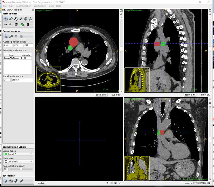 ITK-snap医学图像标注方法（超级详细）——保姆级_itk snap-CSDN博客