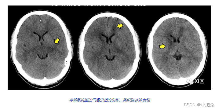 CT伪影：根本原因与规避方法_小鼠ct运动伪影-CSDN博客